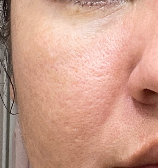 Prescription Treatments for Melasma - Dermatica